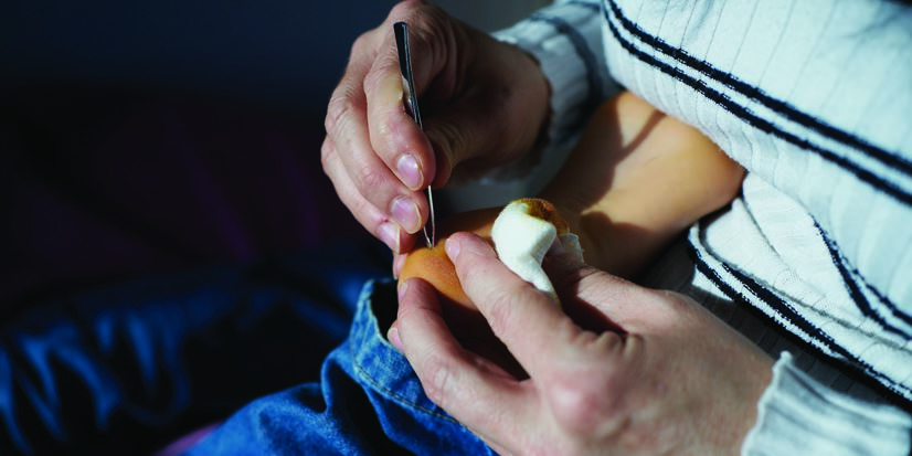 Removing Foreign Object Guide To Foreign Body Management In Endoscopy